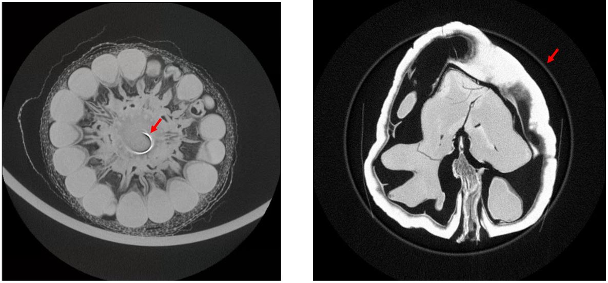 Ring Artifacts Ct | CT artifacts: causes and reduction techniques – LVGFW